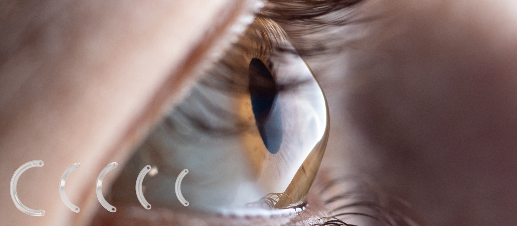 Kerarings (Keratoconus) | EuroEyes